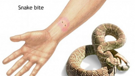 ปฐมพยาบาลอย่างไรเมื่อโดนงูกัด